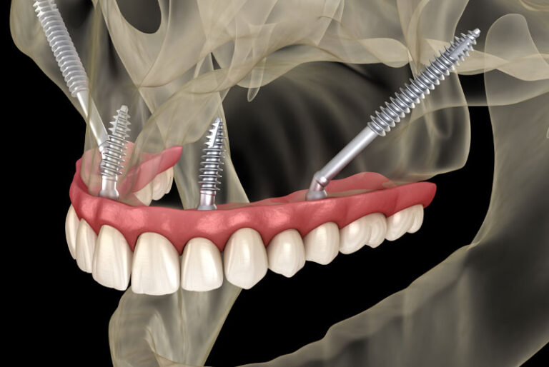 Zygomatic Implants | Sacramento, CA | Aria Perio